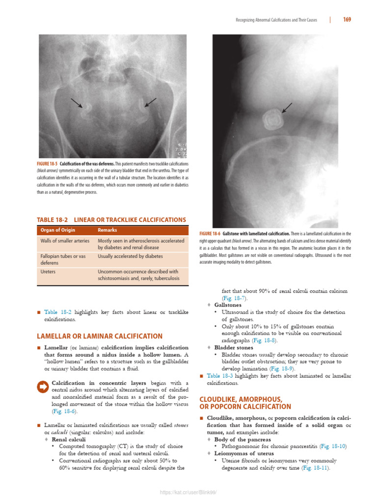 Referensi Nefrolitiasis | PDF | Ct Scan | Kidney