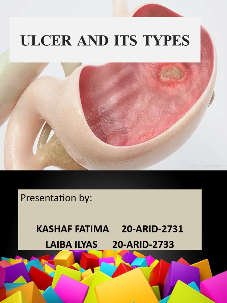 ulcer ppt-1 (1) | Download Free PDF | Medical Specialties | Clinical Medicine