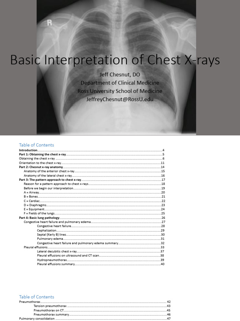 Basic Interpretation of Chest X-Ray | PDF | Lung | Ct Scan