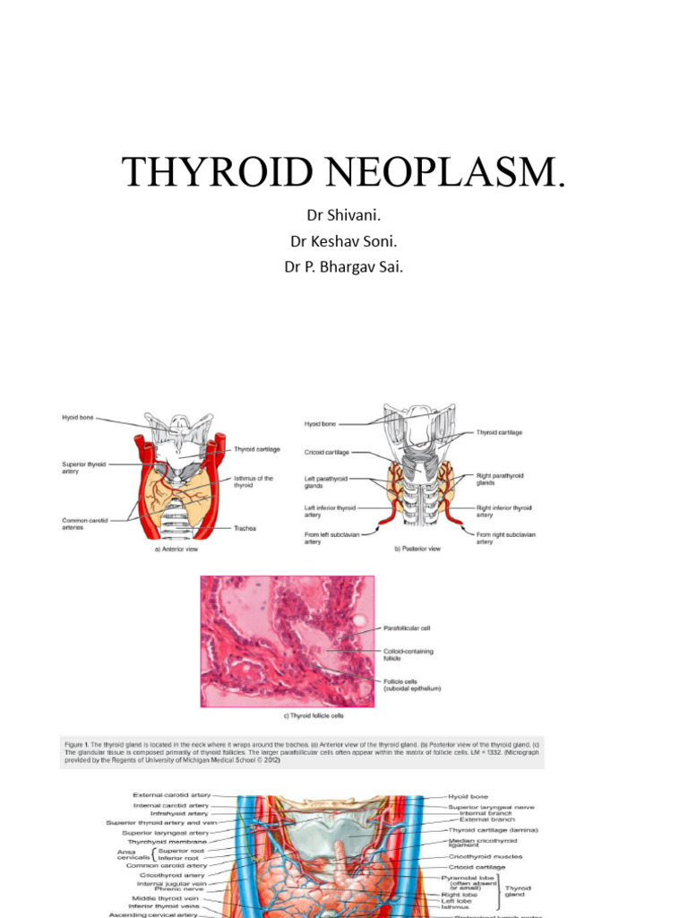 Thyroid Neoplasm Shivani | PDF | Thyroid | Cancer