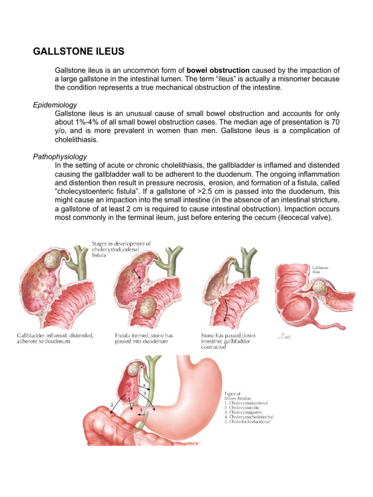 Gallstone Ileus - CC Huevos, Haziel M | PDF | Clinical Medicine ...