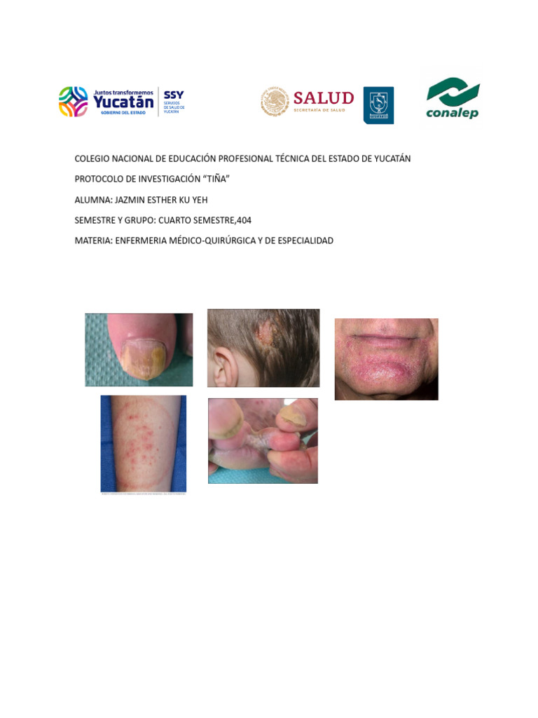 Protocolo Tiña | PDF | Piel | Epidermis
