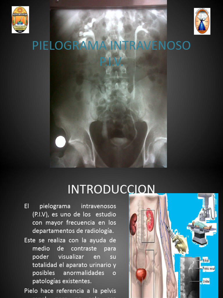 Pielograma Intravenoso P.I.V | PDF | Riñón | Sistema urinario