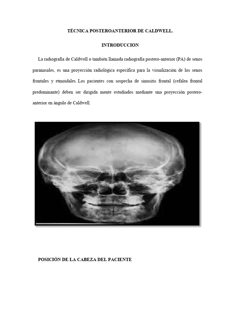 Tecnica Posteroanterior de Caldwell | PDF | Cabeza y cuello humanos