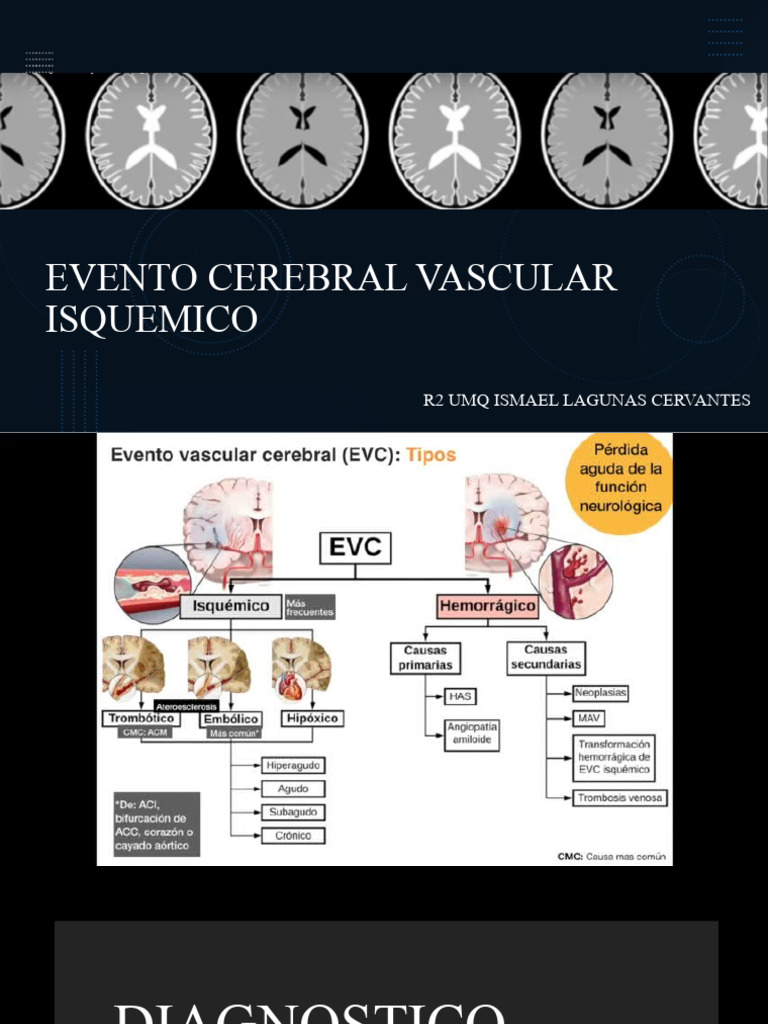 EVC ISQUEMICO | PDF | Enfermedades y trastornos humanos | Medicina CLINICA