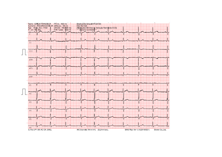 Modelo de Ecg | PDF