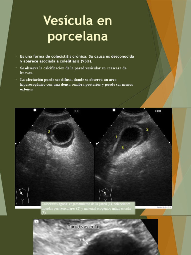 Vesícula en porcelana y WES | PDF