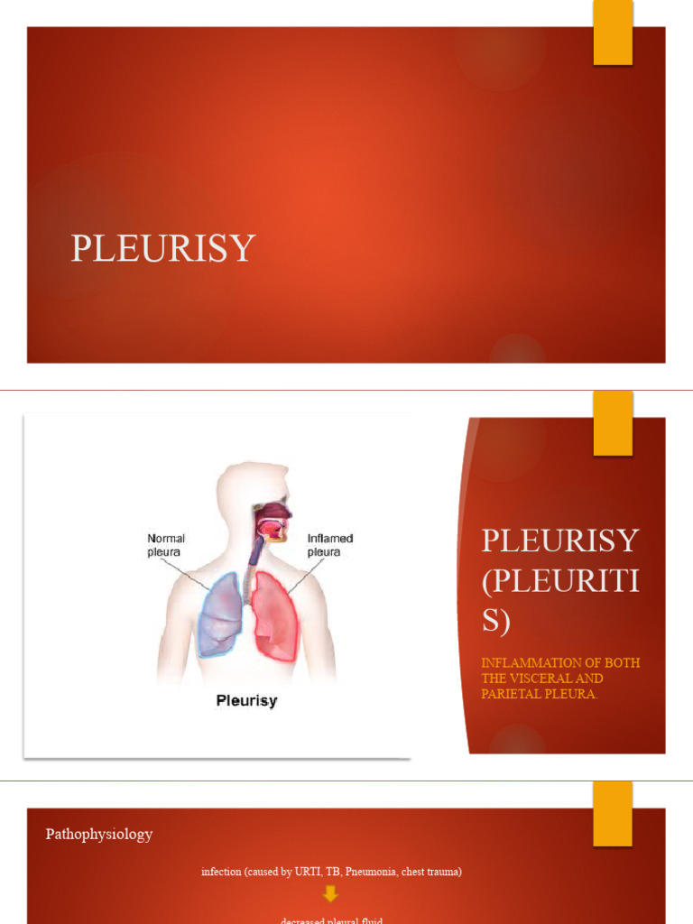 2 - Pleurisy, Pleural Effusion and Empyema | PDF | Diseases And Disorders | Medical Specialties