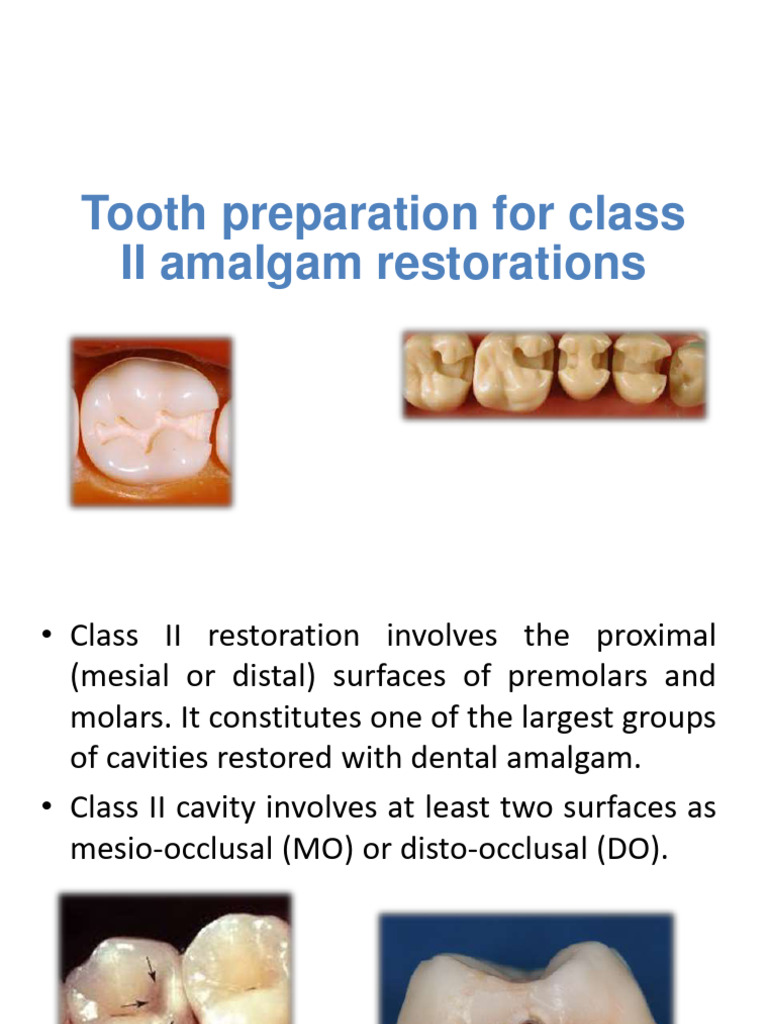 Class 2 Cavity Prep | PDF | Tooth Enamel | Human Tooth