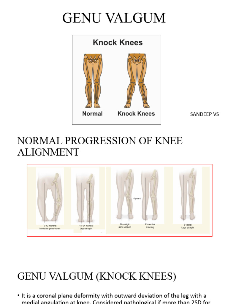 Genu Valgum | PDF | Knee | Diseases And Disorders