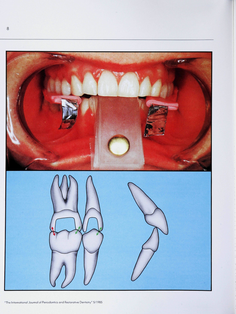 Occlusal Adjustment Via Selective Cuting of Natural Teeth | PDF | Mouth ...