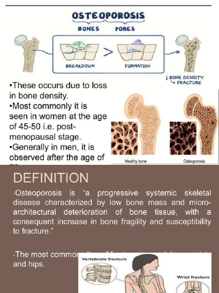 osteo porosis | PDF