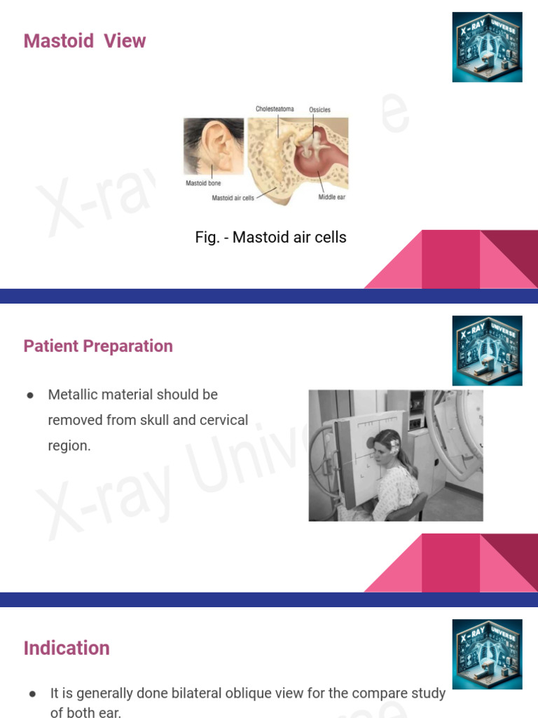 Mastoid View: Fig. - Mastoid Air Cells | PDF