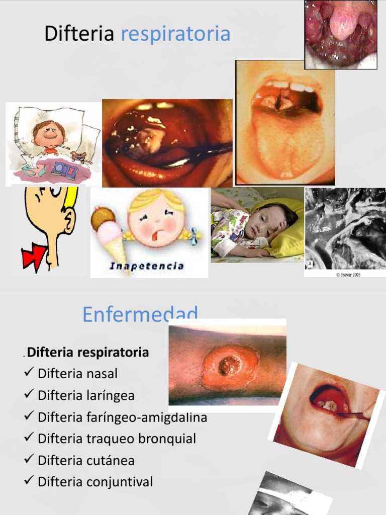 Difteria | PDF | Especialidades Medicas | Enfermedades y trastornos