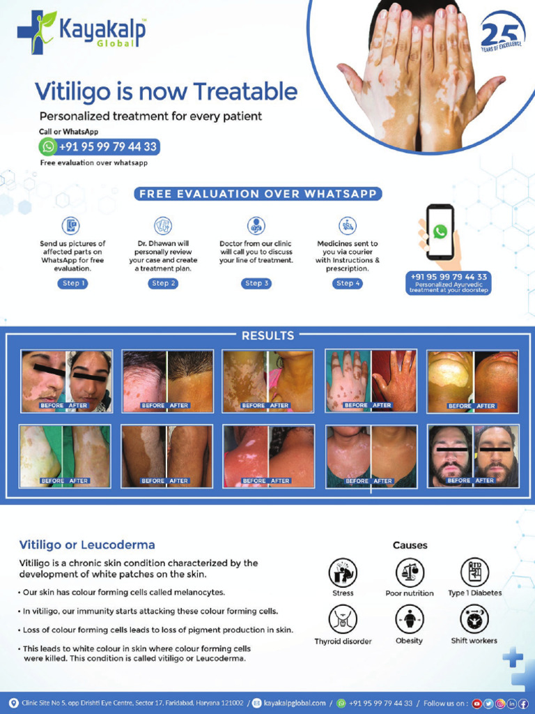 Vitiligo | PDF