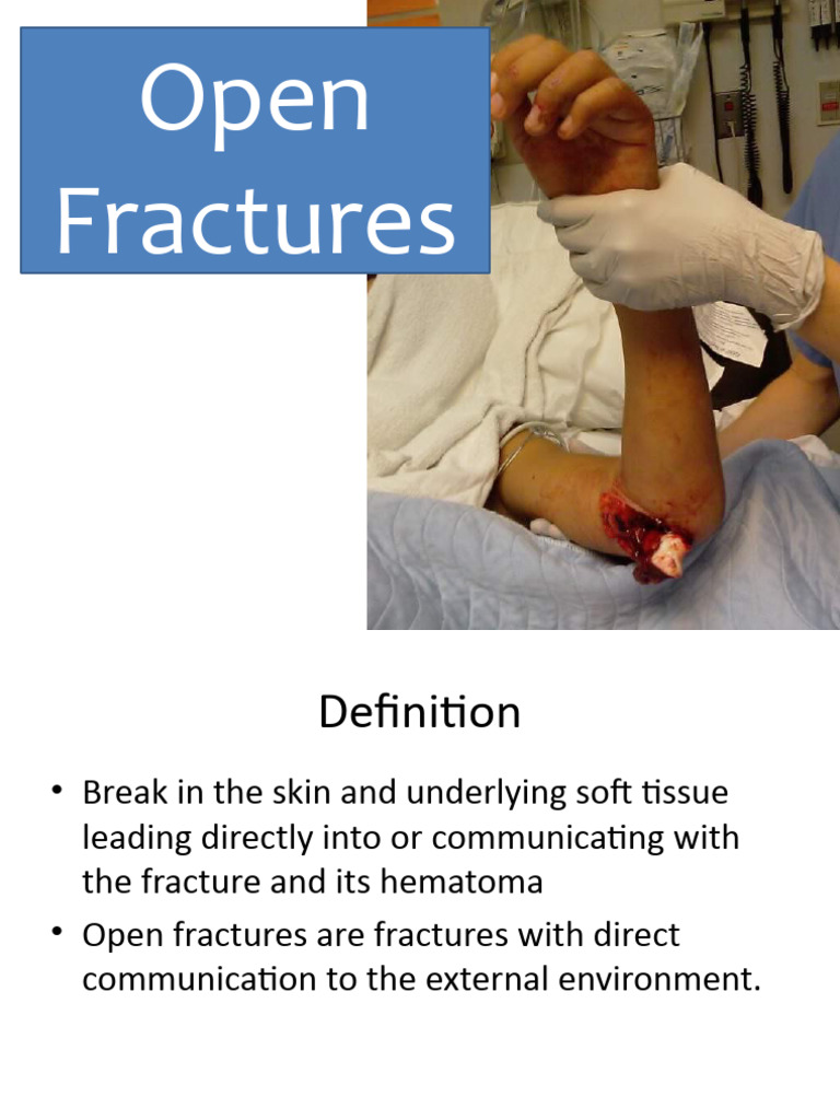 Management of Open Fractures | PDF | Wound | Amputation