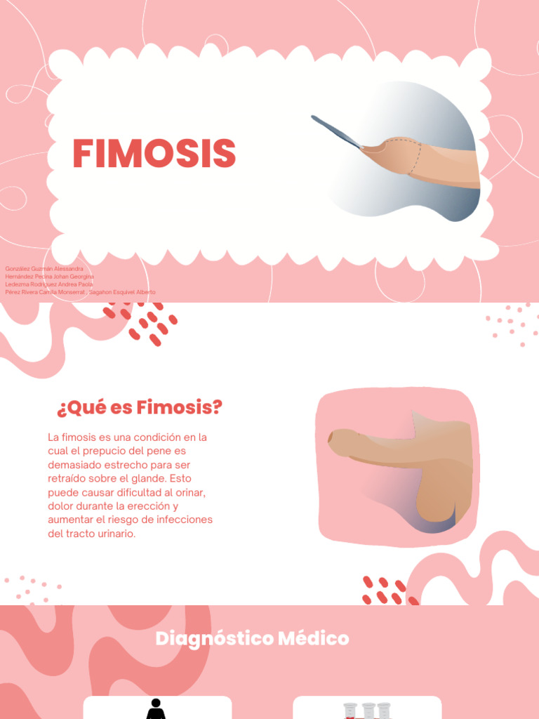 Diapositivas fimosis presentación | PDF | Circuncisión | Causas de la ...