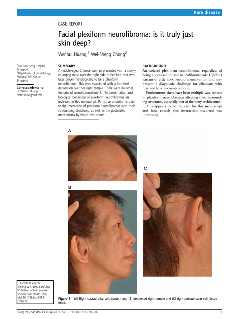 Facial plexiform NF | PDF | Neoplasms | Clinical Medicine
