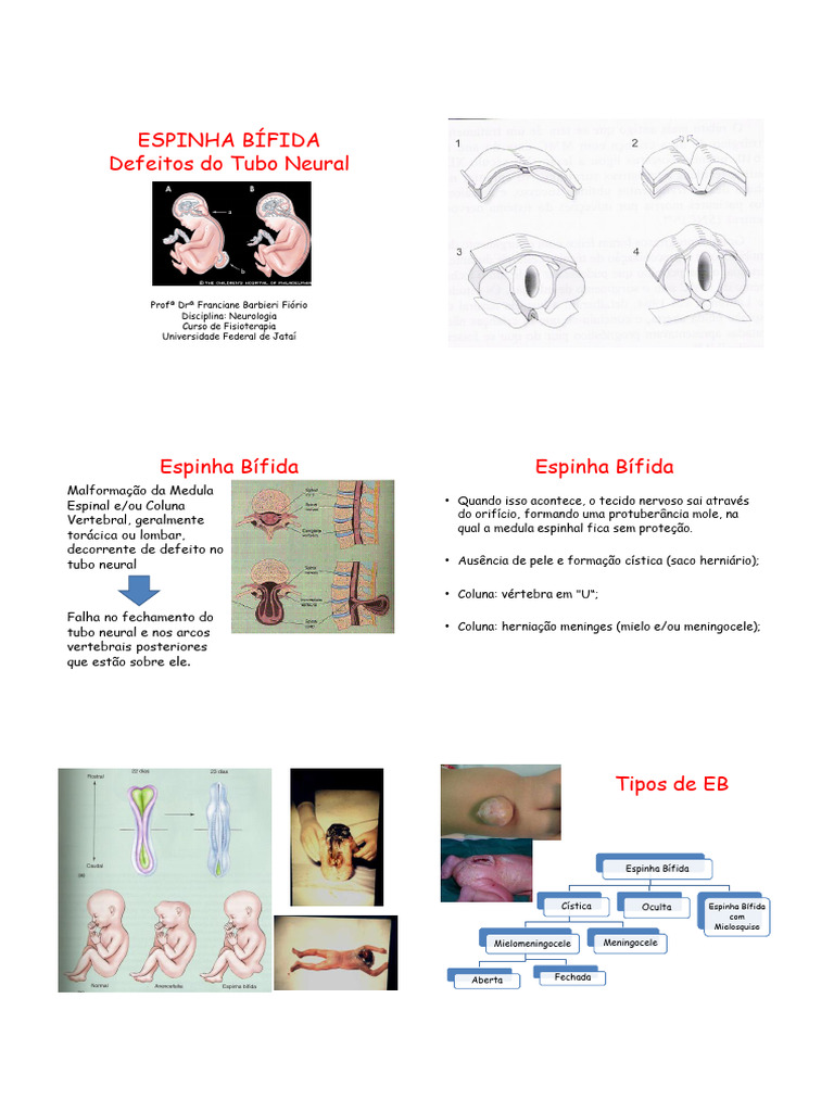 ESPINHA BÍFIDA | PDF | Coluna vertebral | Líquido cefalorraquidiano