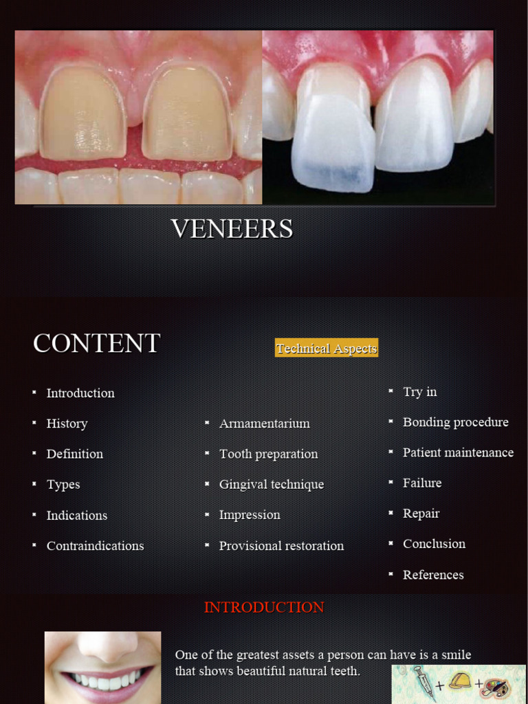 VII. Veneer | PDF | Dental Composite | Tooth Enamel
