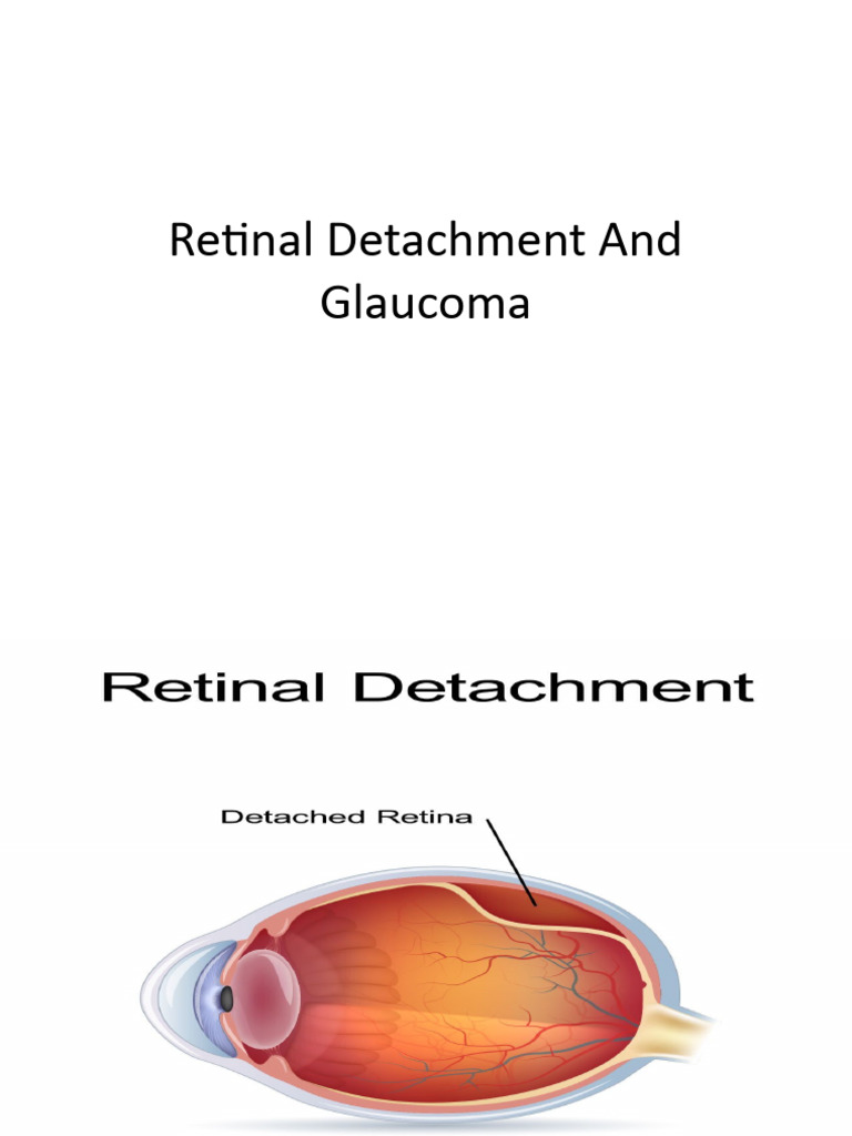 Glaucoma and Retinal Detachment | PDF | Glaucoma | Retina