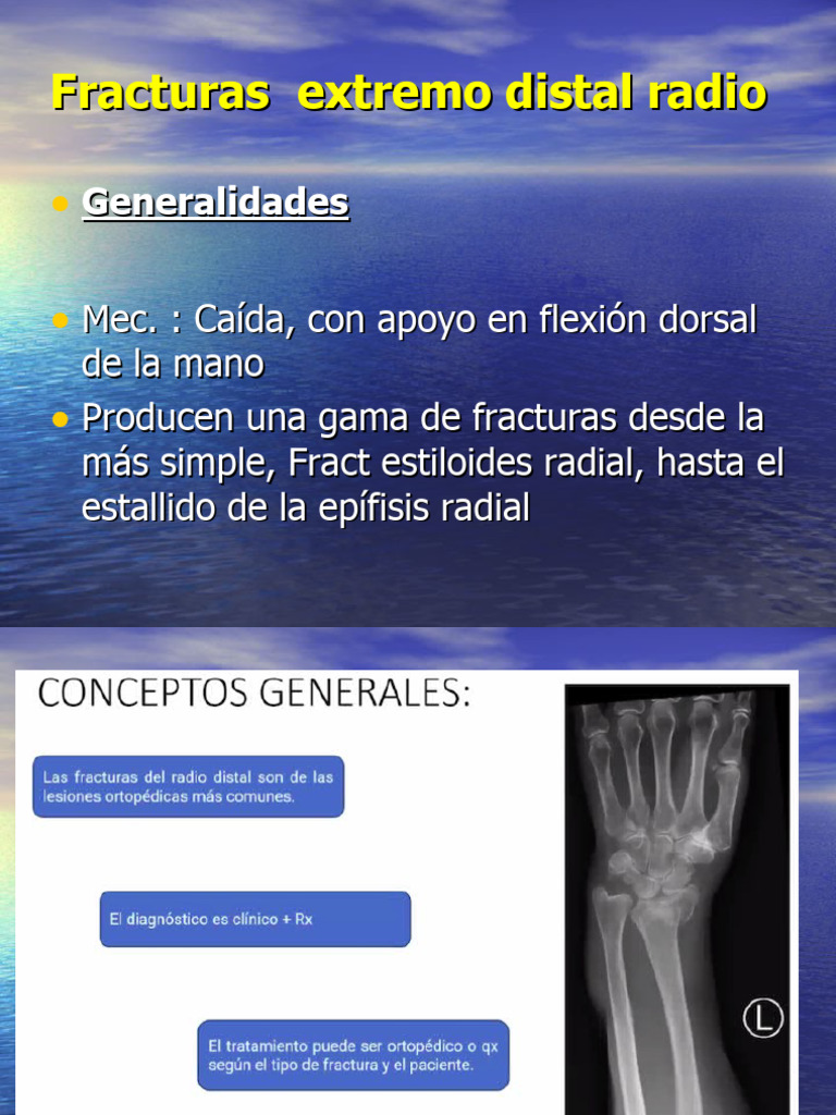 Fracturas Extremo Distal Radio | PDF | Articulación | Mano