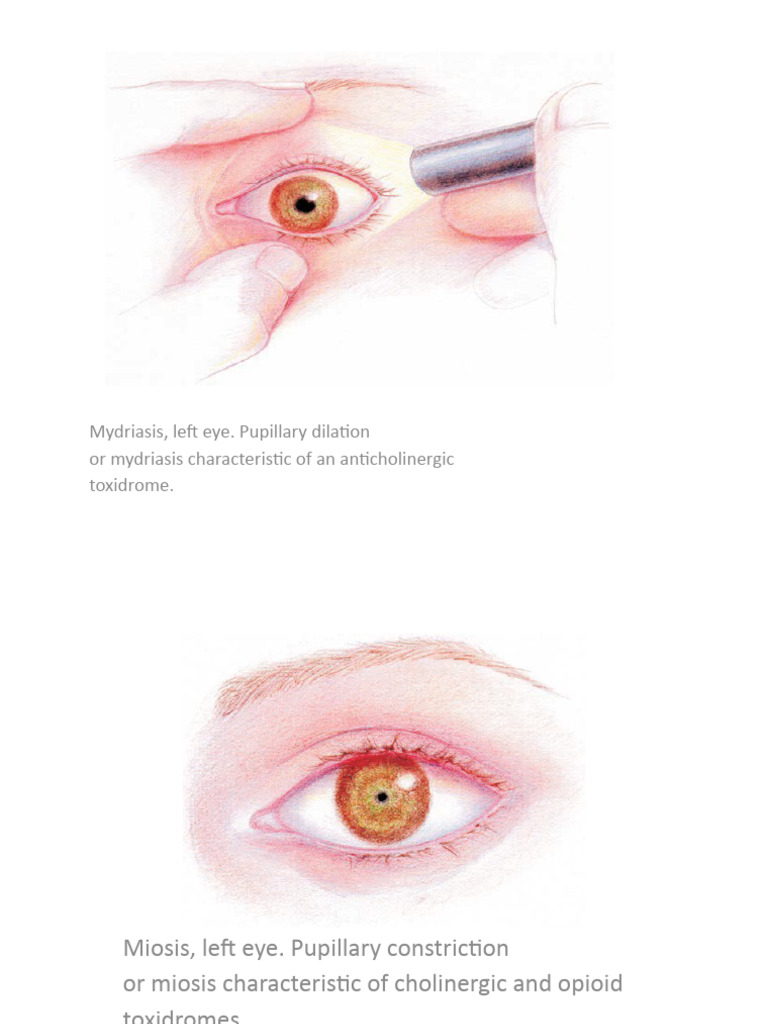 Left Eye Mydriasis & Miosis Causes | PDF