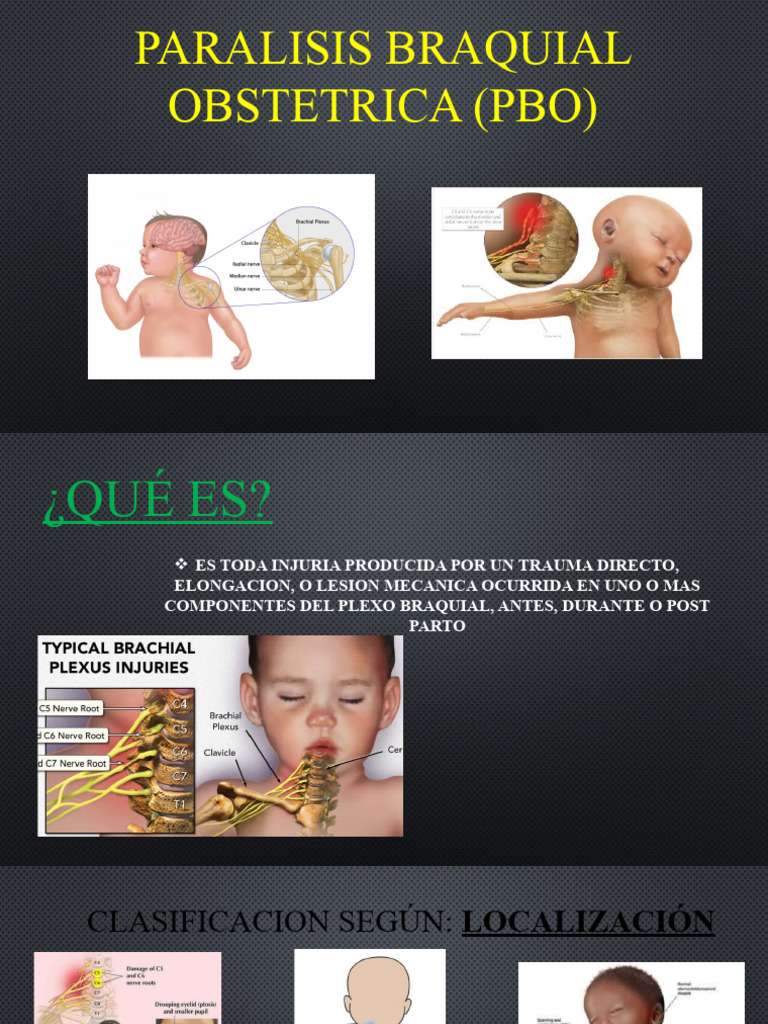 Paralisis Braquial Obstetrica (Pbo) | PDF