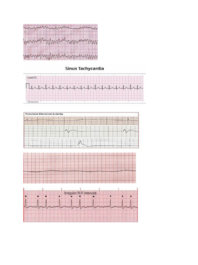 Contoh Gambar Irama Ekg | PDF