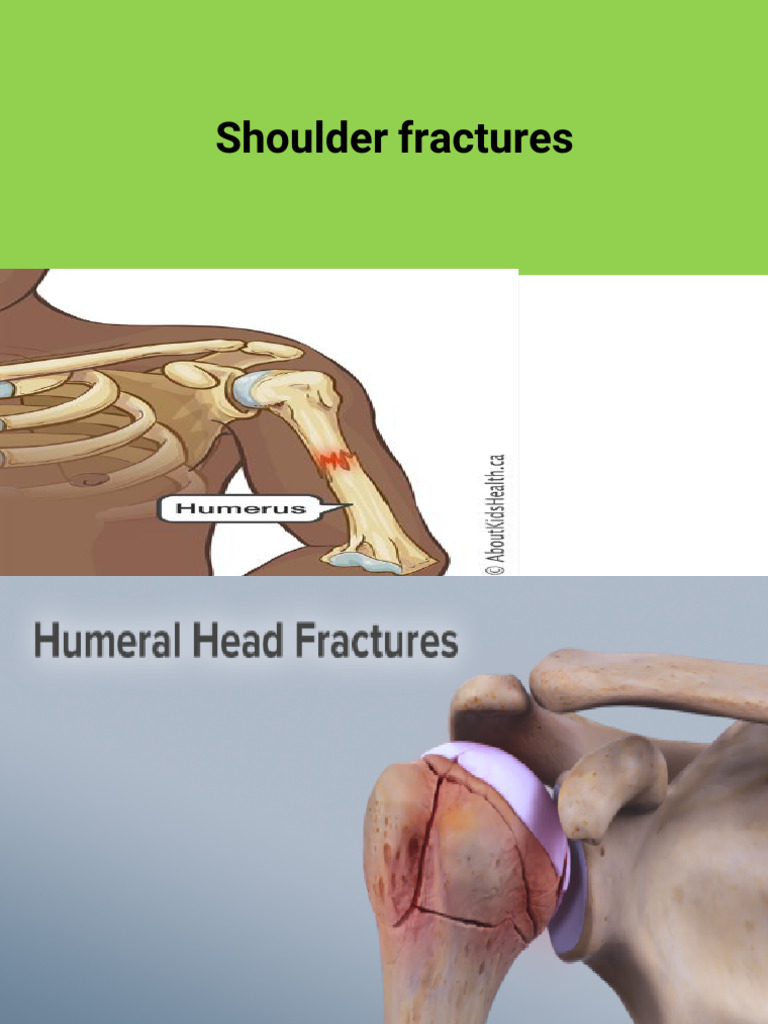 Shoulder Fractures (Distal Humer, Diapisis) Lecture 6.Pptm | PDF ...