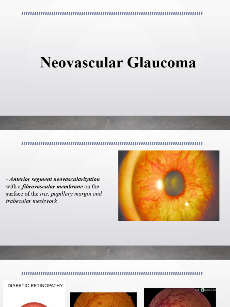 Neovascular glaucoma | PDF