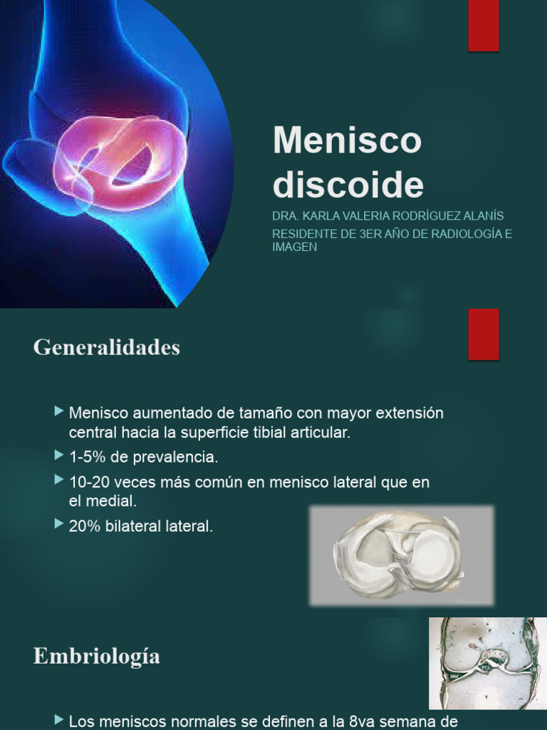 Menisco Discoide | PDF | Articulaciones | Sistema musculoesquelético