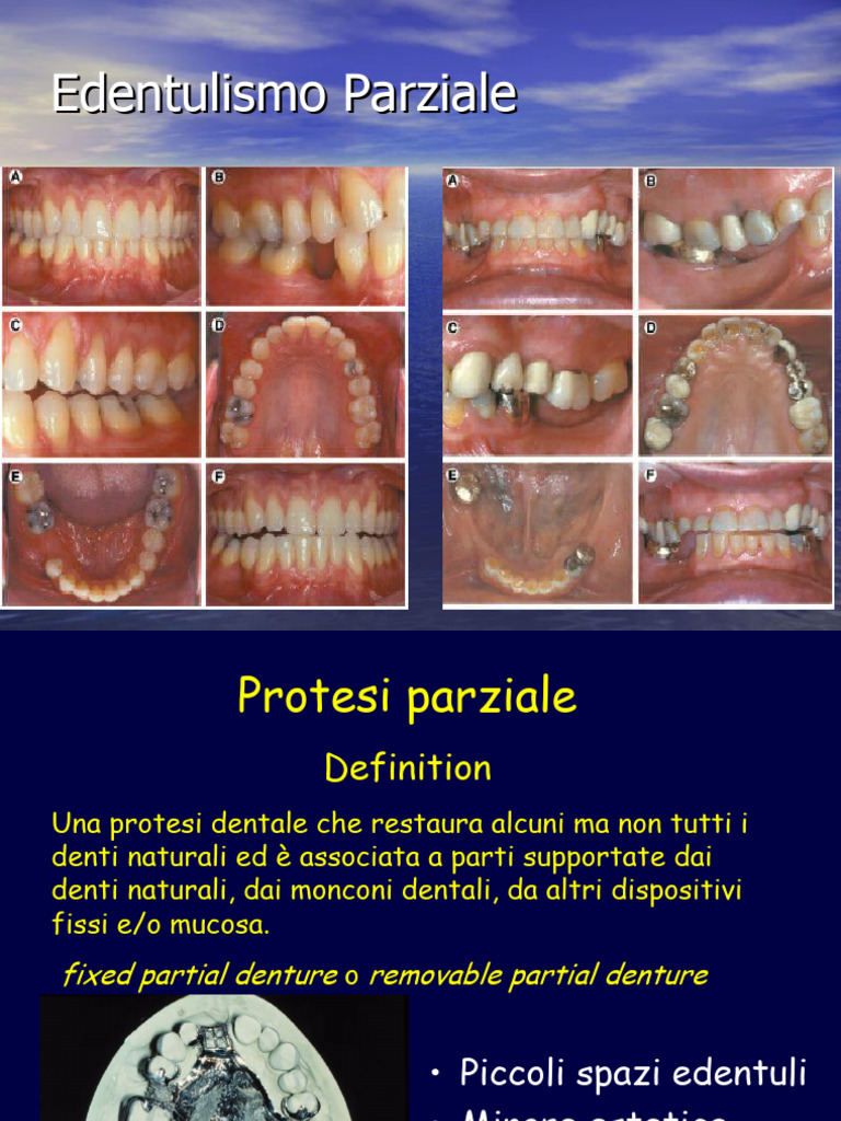 23.protesi Parziale | PDF | Dentures | Mouth