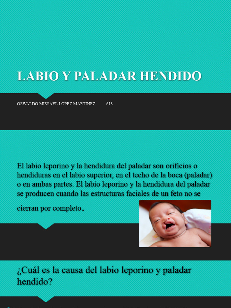 LABIO Y PALADAR HENDIDO Misael | PDF | Enfermedades y trastornos ...