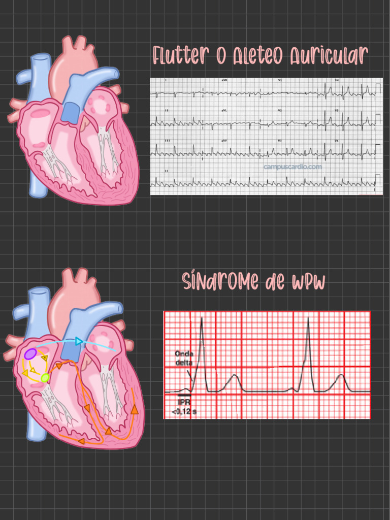 Flutter o Aleteo Auricular | PDF