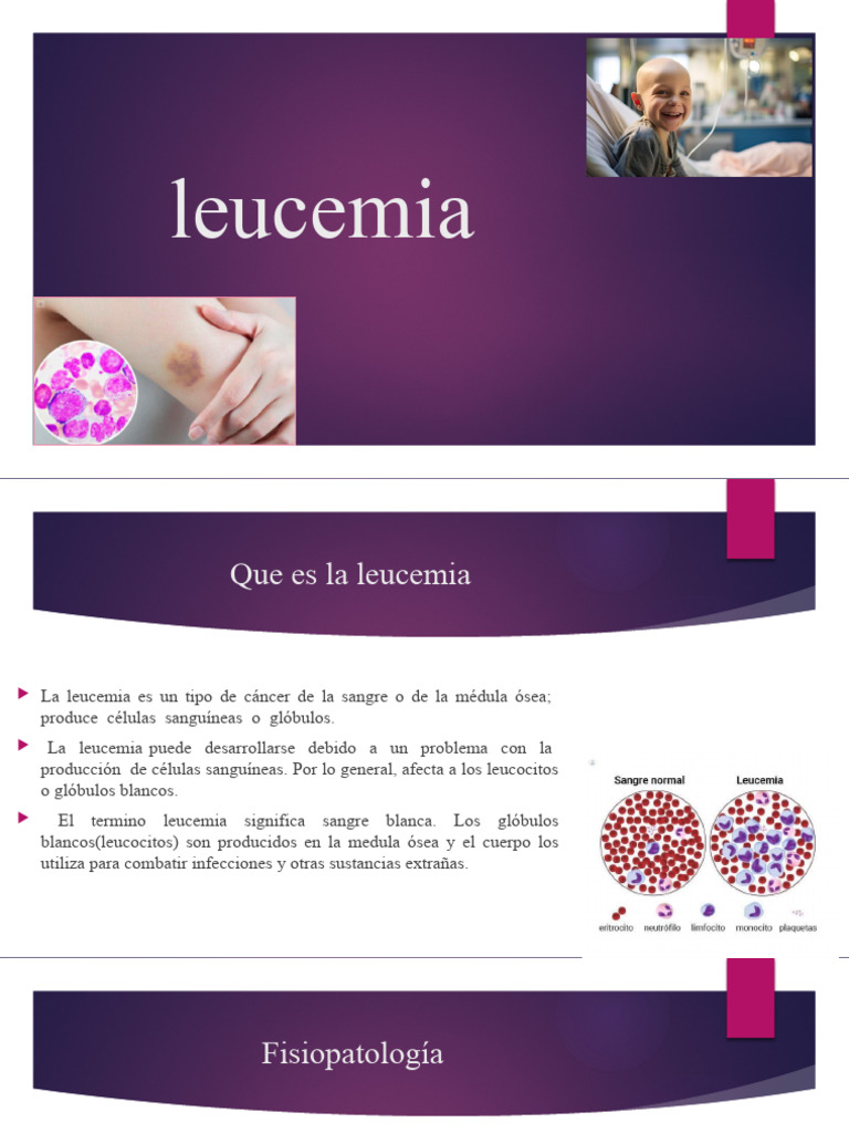 Tipos y Tratamientos de Leucemia | PDF | Leucemia | Sangre