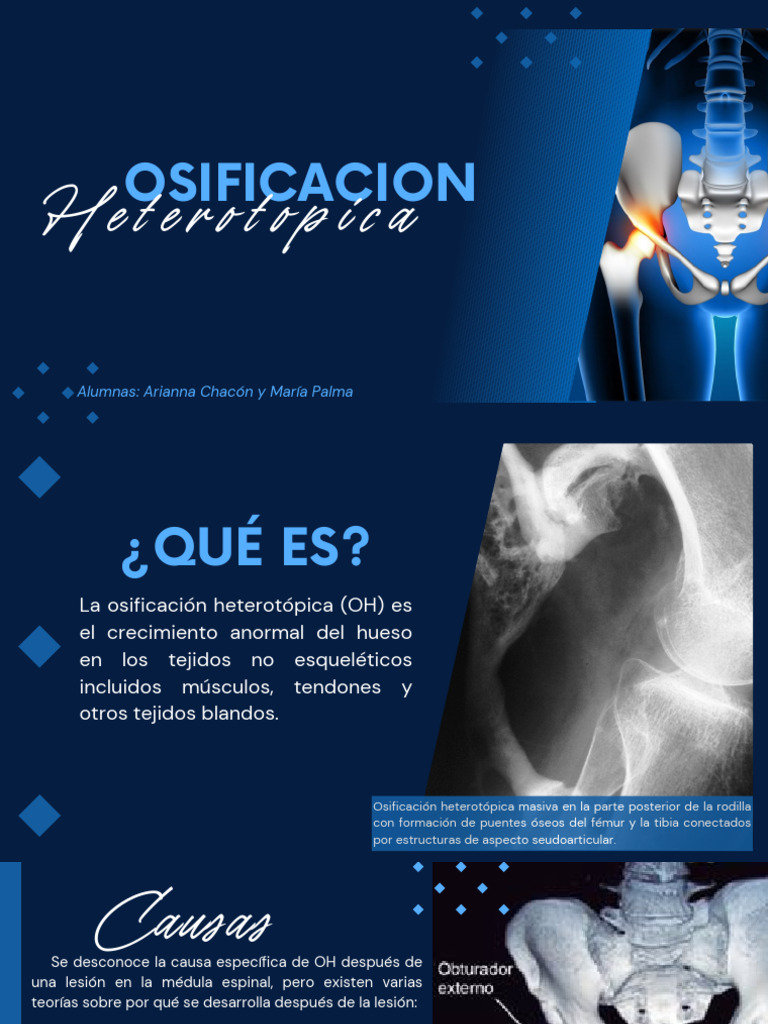 Presentacion Osificacion Heterotopica Pdf Hueso Dolor