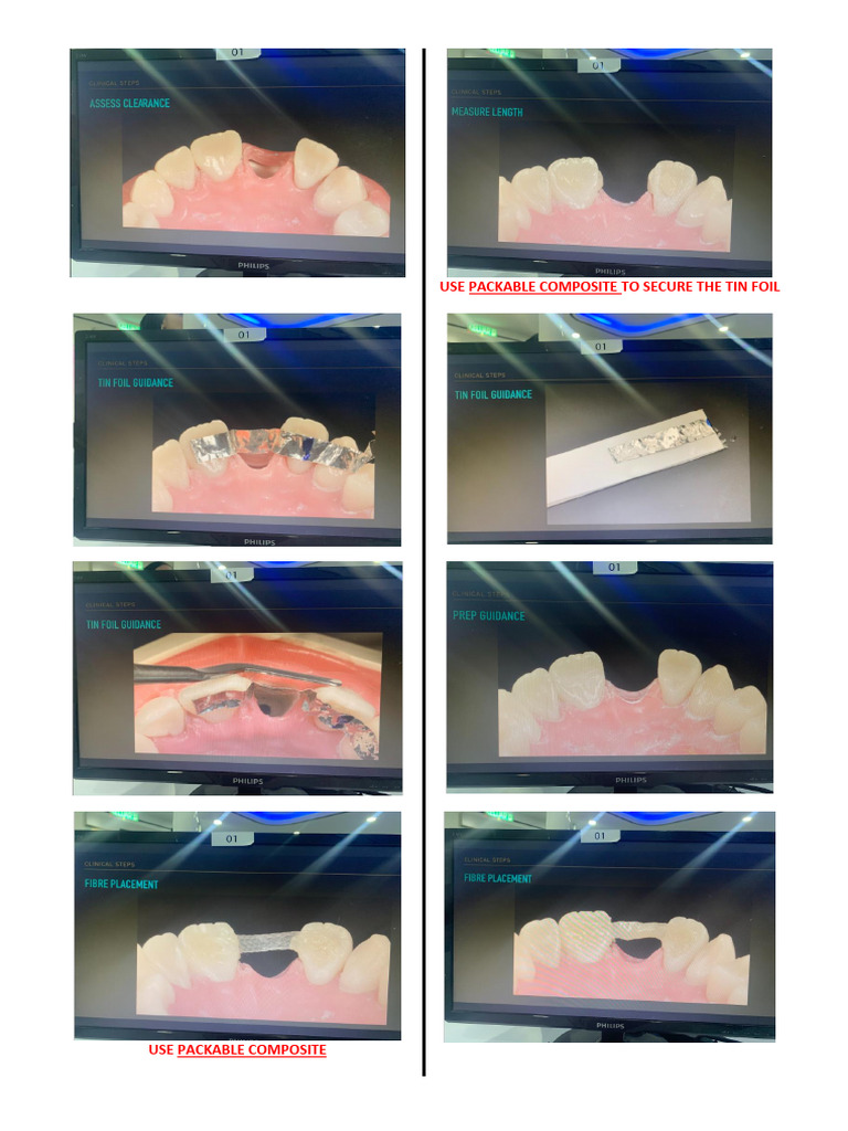 Use Packable Composite To Secure The Tin Foil | PDF
