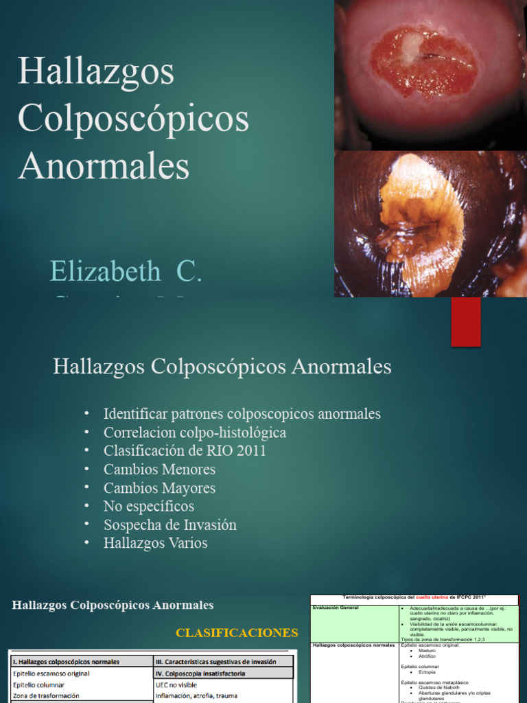 CONFERENCIA Hallazgos Colposcópicos Anormales | PDF | Epitelio ...