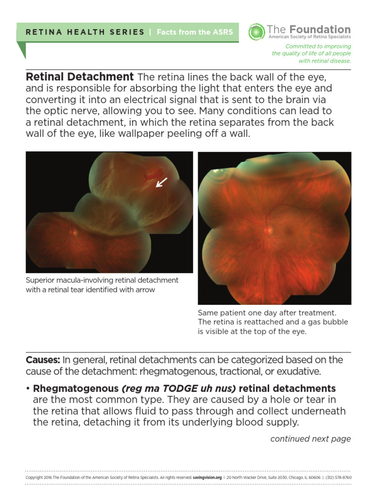 Fact Sheet 4 LP Retinal Detachment r2 | PDF | Retina | Senses