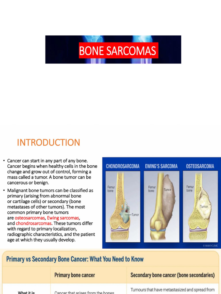 Bone Sarcomas | PDF
