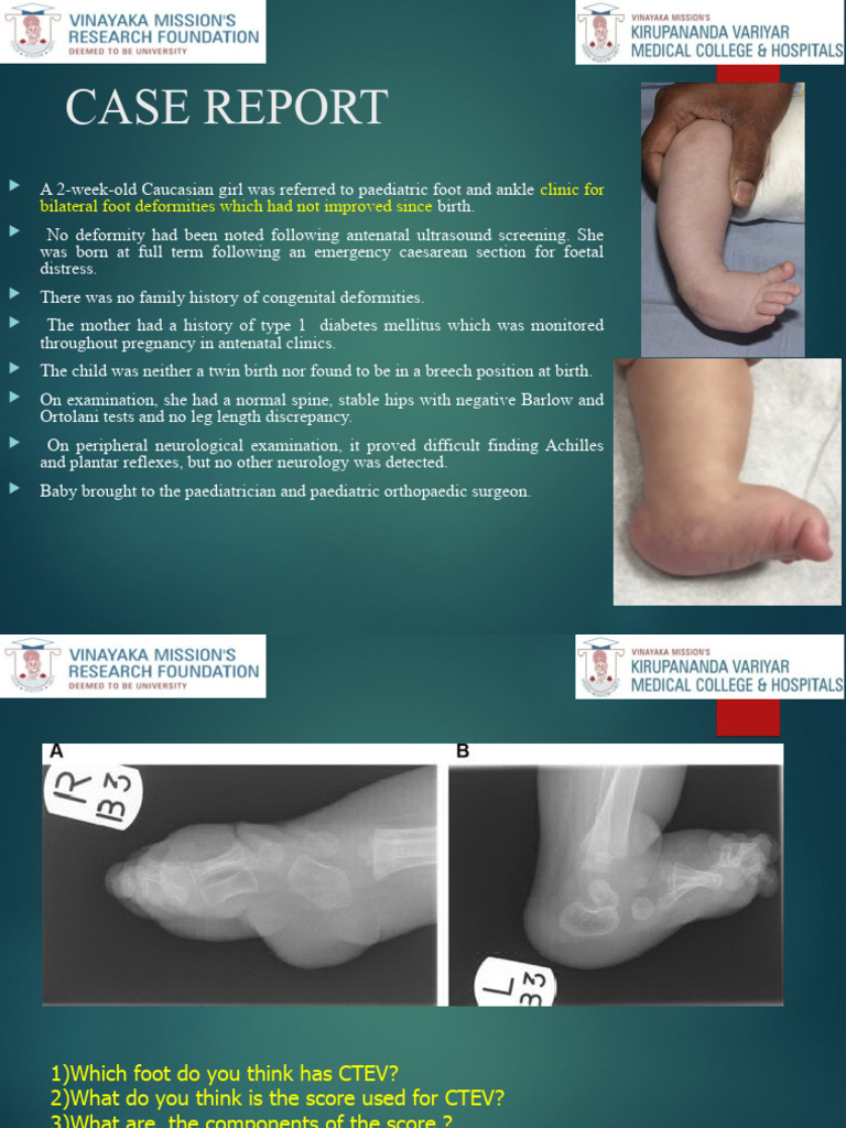 CTEV | PDF | Foot | Diseases And Disorders