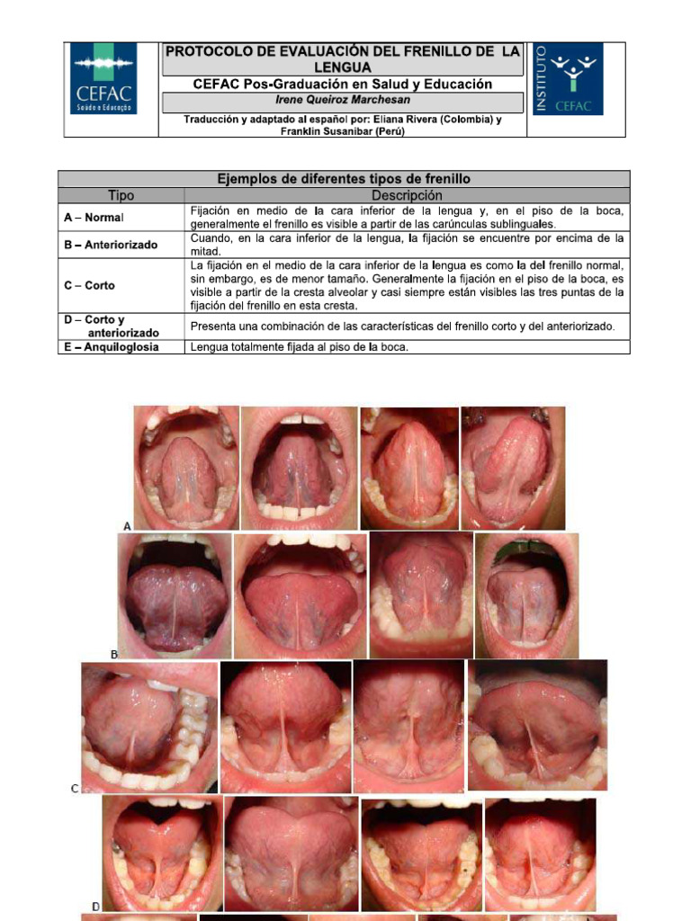 Frenillo Evaluacion | PDF