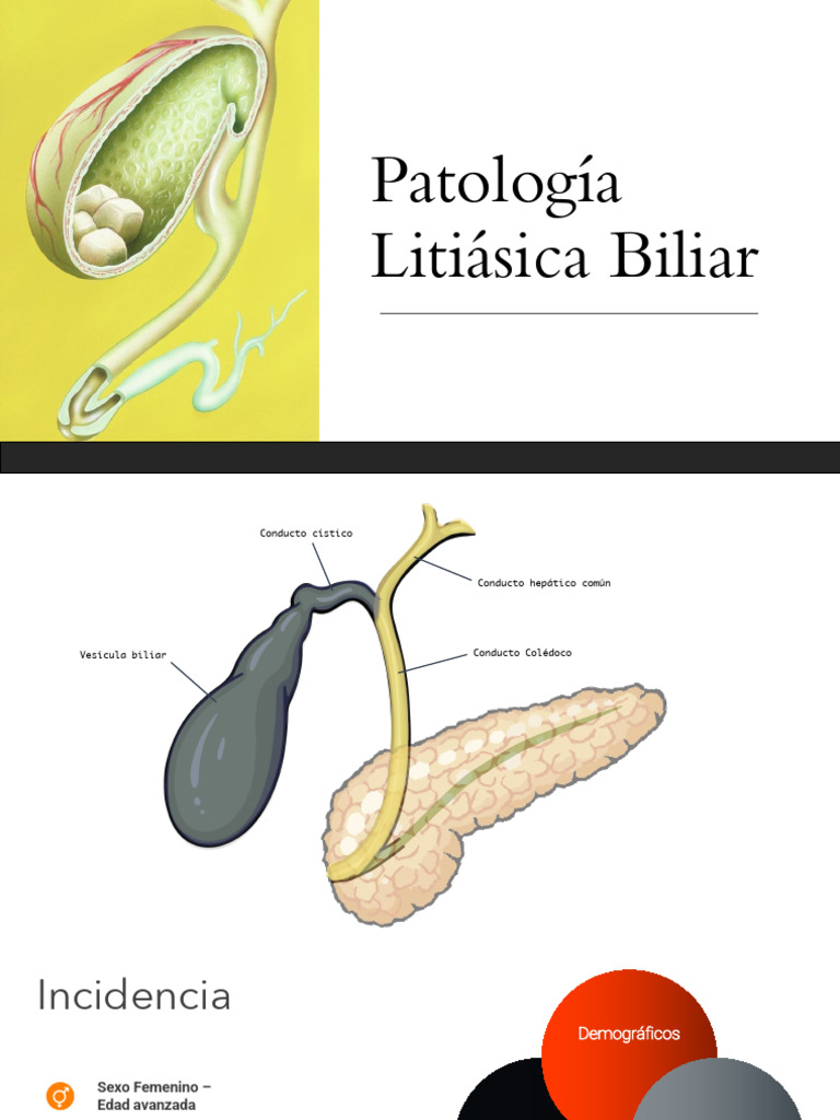Litiasis Biliar | PDF | Hígado | Vesícula biliar