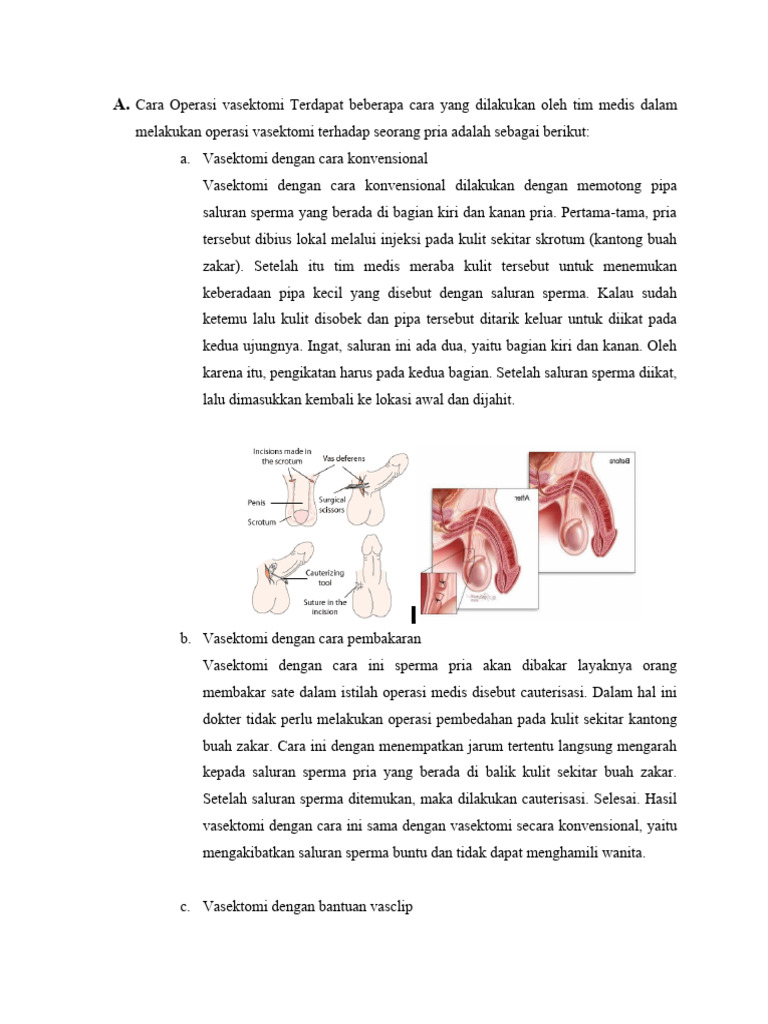 Metode Vasektomi: Konvensional, Cauterisasi, Vasclip | PDF | Sains ...
