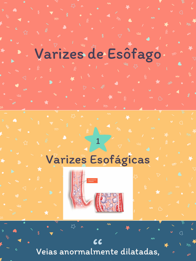 Gastro Aula 3 - Hipertesão-Porta-E-Varizes-De-Esôfago | PDF ...