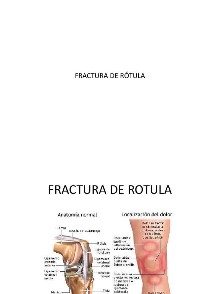 Fractura de Rotula | PDF | Rodilla | Sistema esquelético