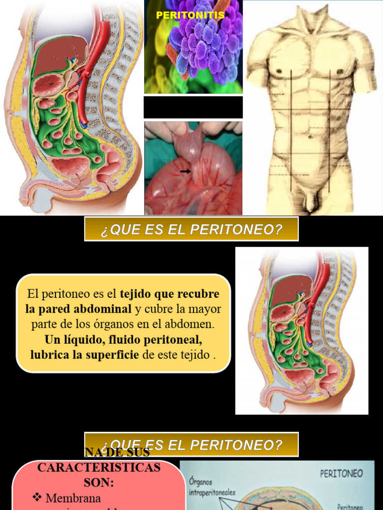 Peritonitis | PDF | Inflamación | Peritoneo