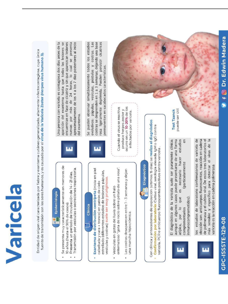 VARICELA | PDF