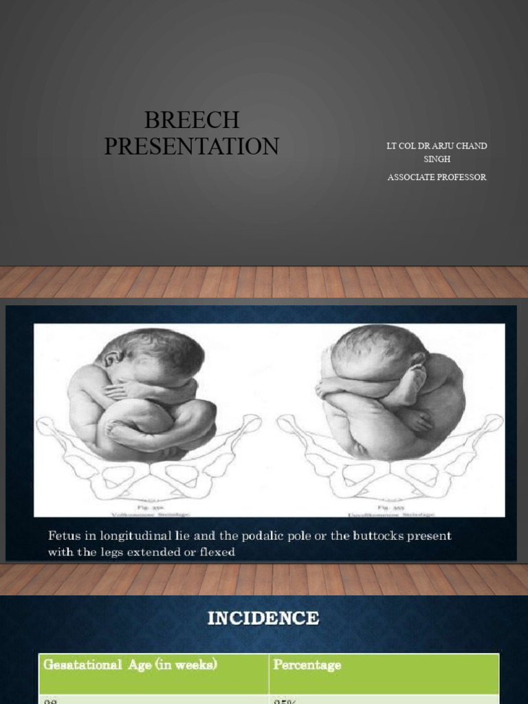 Breech Presentation | PDF